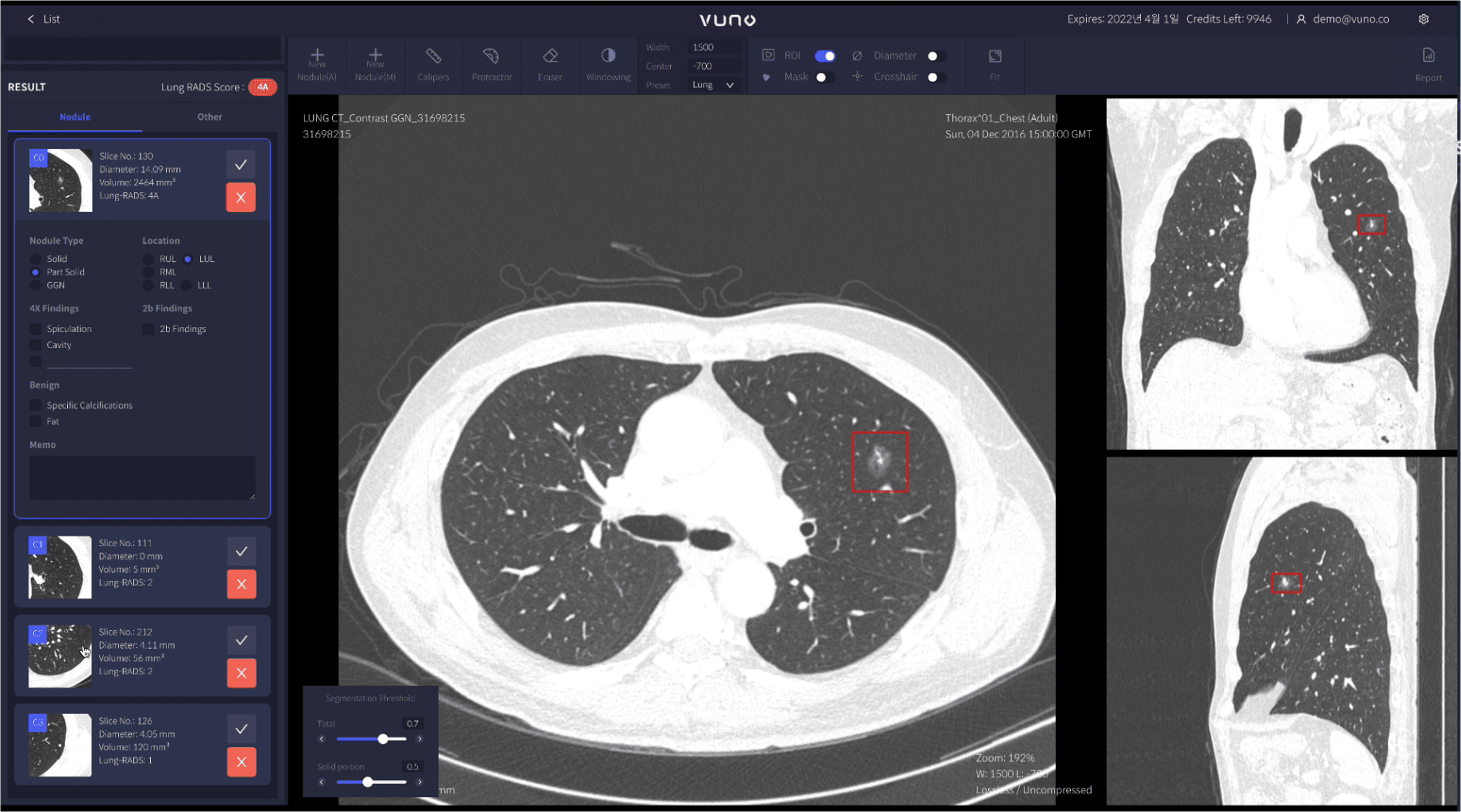 Lung Cancer Detection | MLove